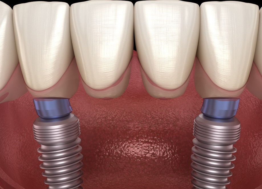 The Ways Dental Implants Restore Smiles Better | Leawood, KS