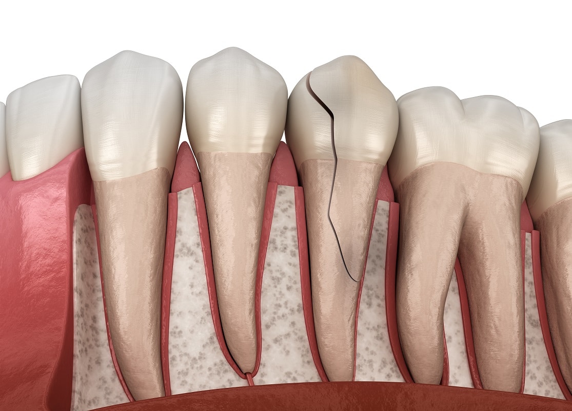 How To Treat A Cracked Tooth Conservatively Leawood KS