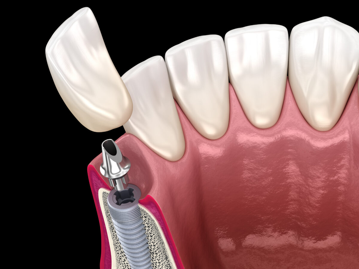 Replacing Your Missing Teeth With Prosthetics | Leawood, KS
