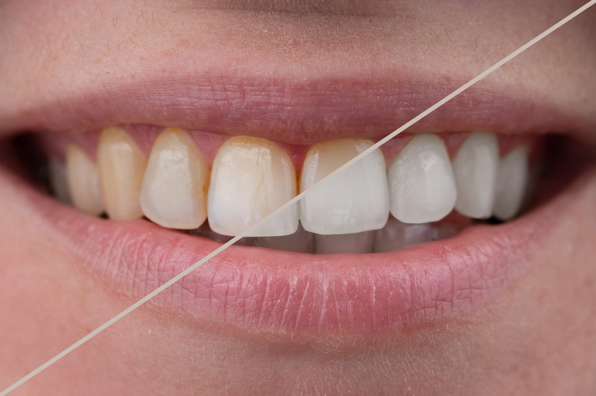 Helping You Brighten Your Smile With Whitening | Leawood, KS